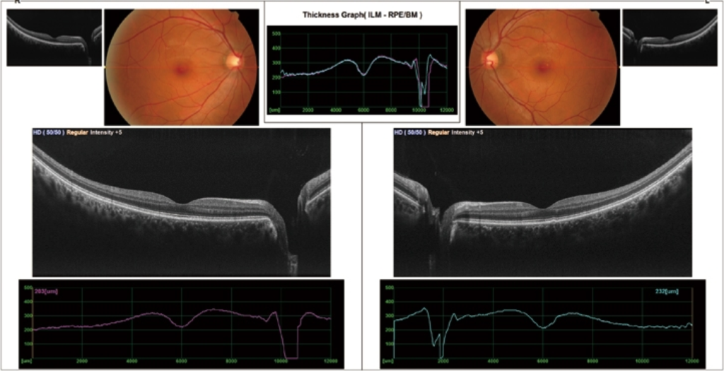 OCT example image | Trusted Calgary Optometrist | Macleod Optometry